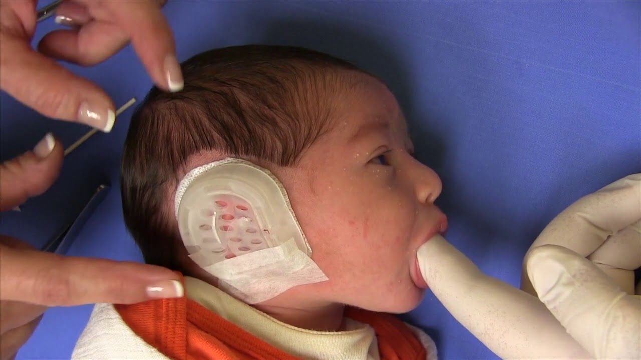 Prominent Ear Lobule Treatment with the EarWell® Infant Ear Deformity ...