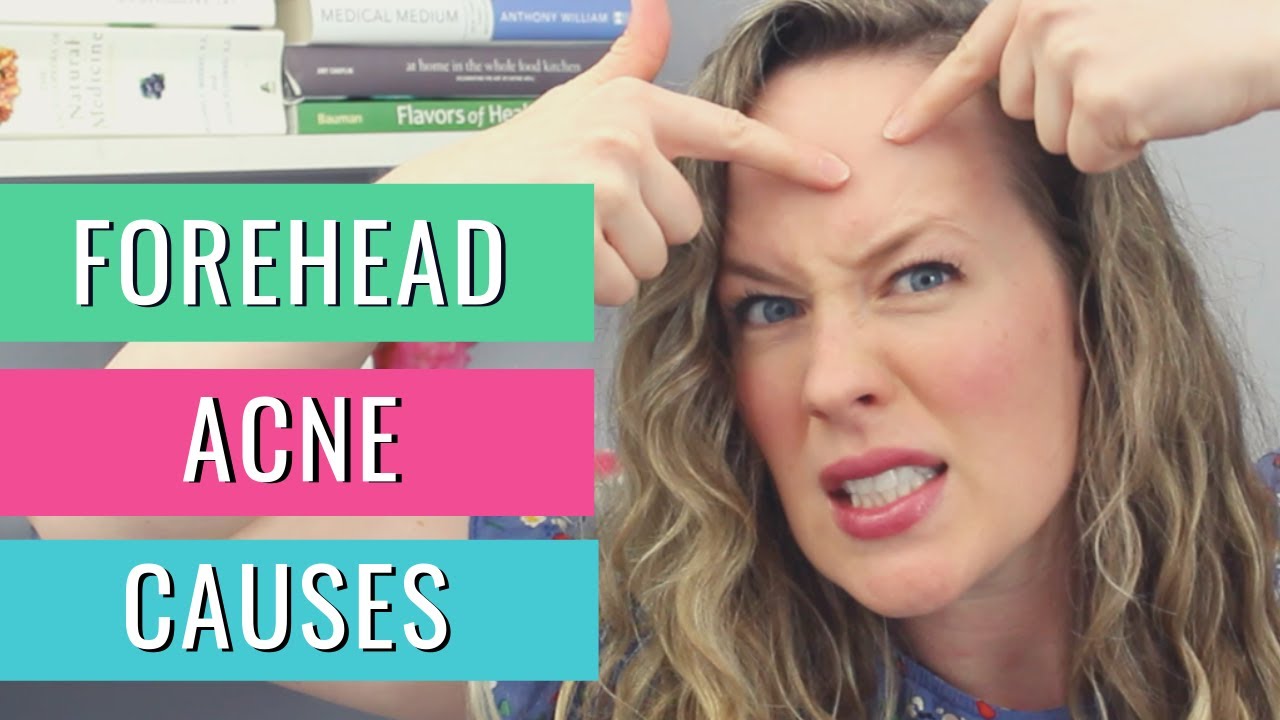 What causes forehead acne? ZAP TINY FOREHEAD ACNE BUMPS FAST! - YouTube