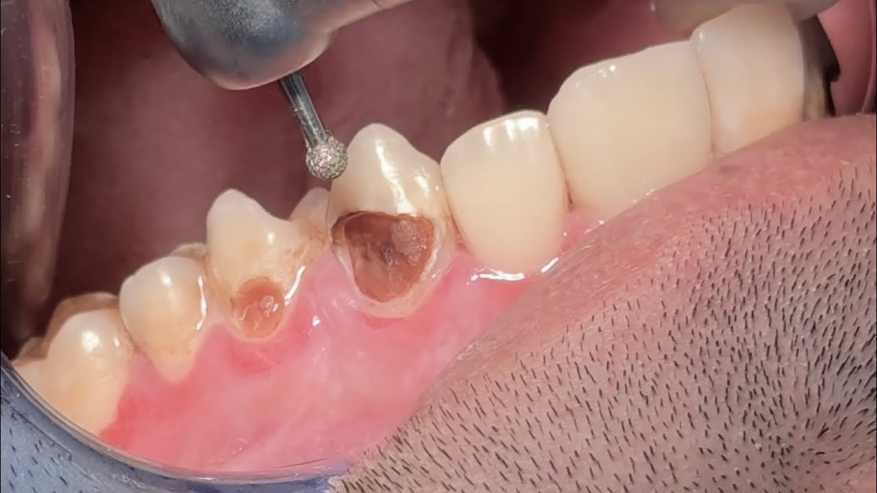 Deep Cavity In Anterior Canine Tooth 🦷 🦷 - YouTube