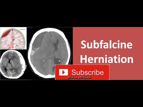 Subfalcine Herniation - YouTube