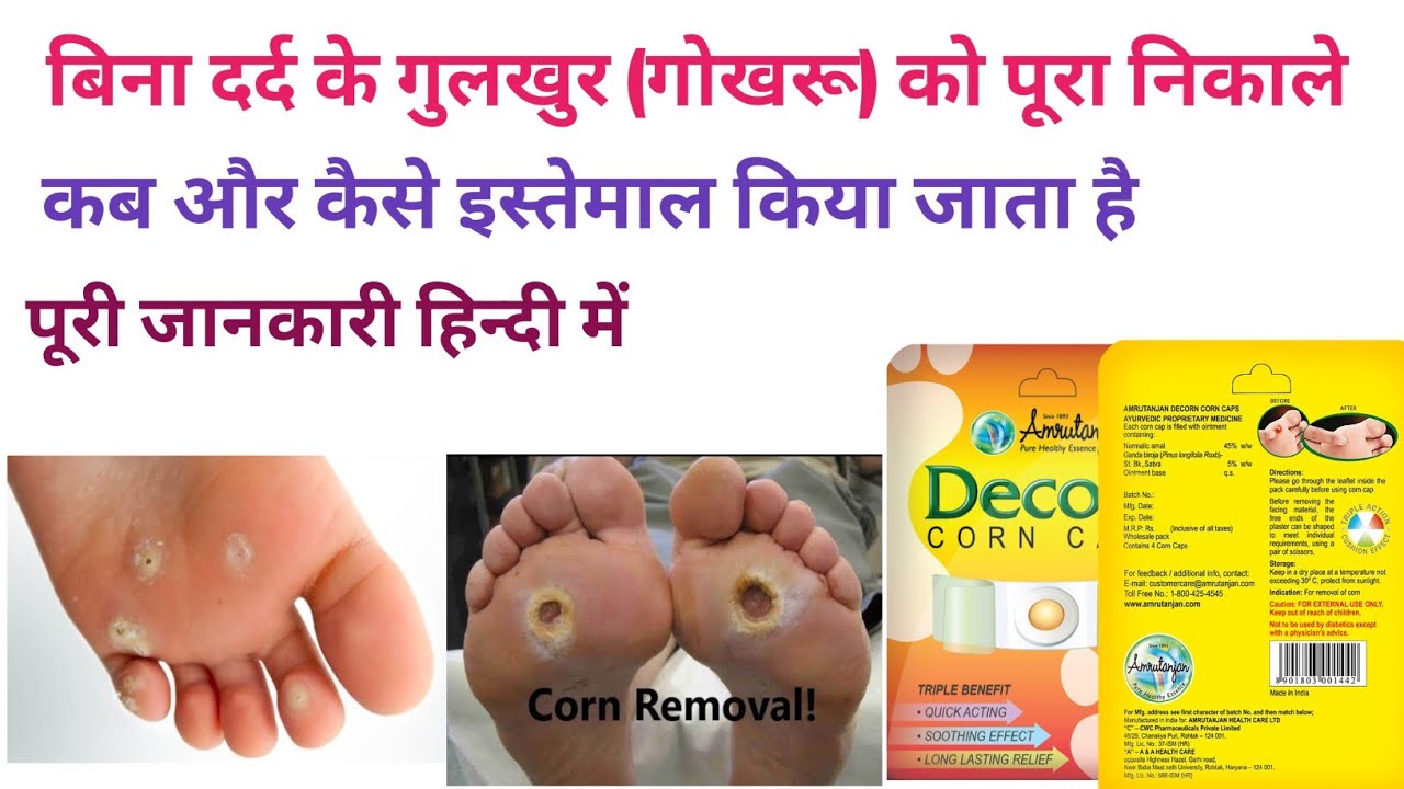 Corn Cap Remove Bandage 🩹 | गुलखुर ( गोखरू ) को बिना दर्द निकाले | Corn ...