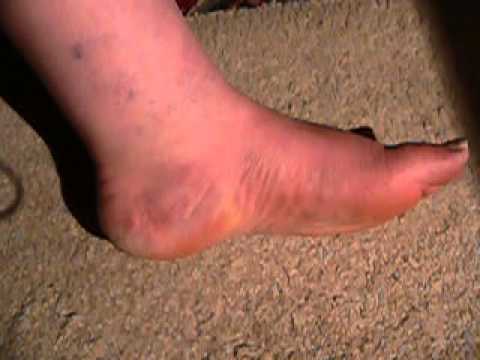 My Lyme ACA Bartonella Babesia Foot 29 years infected - YouTube