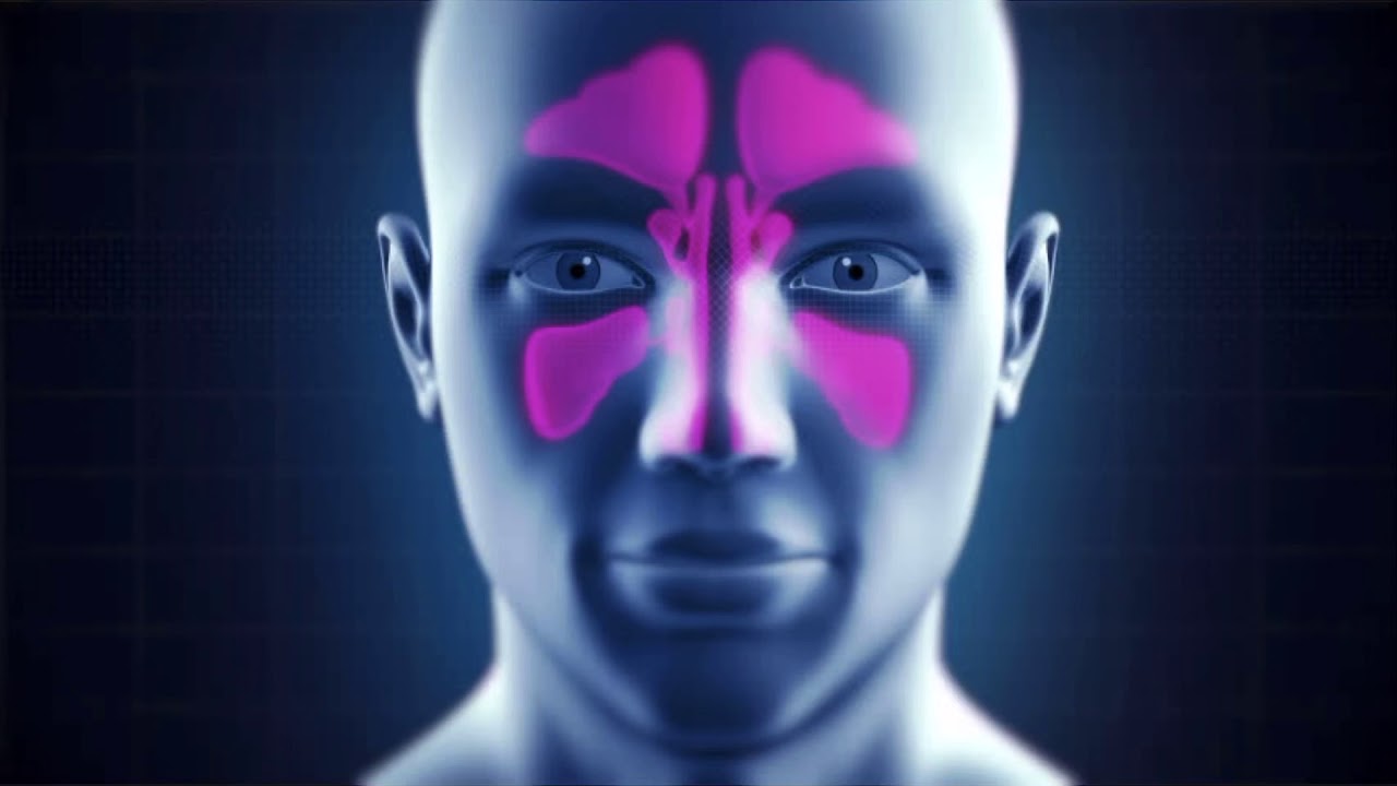 Maxillary sinus (diseases) - YouTube