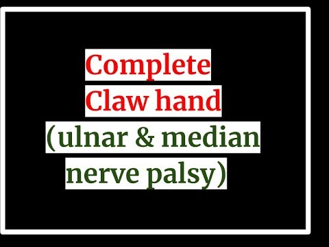 claw hand, Complete ( ulnar & median nerve palsy) - YouTube