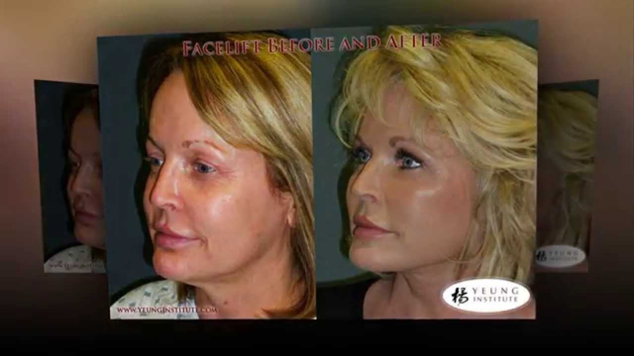 Facelift Surgery Houston TX - Before & After Photos - YouTube