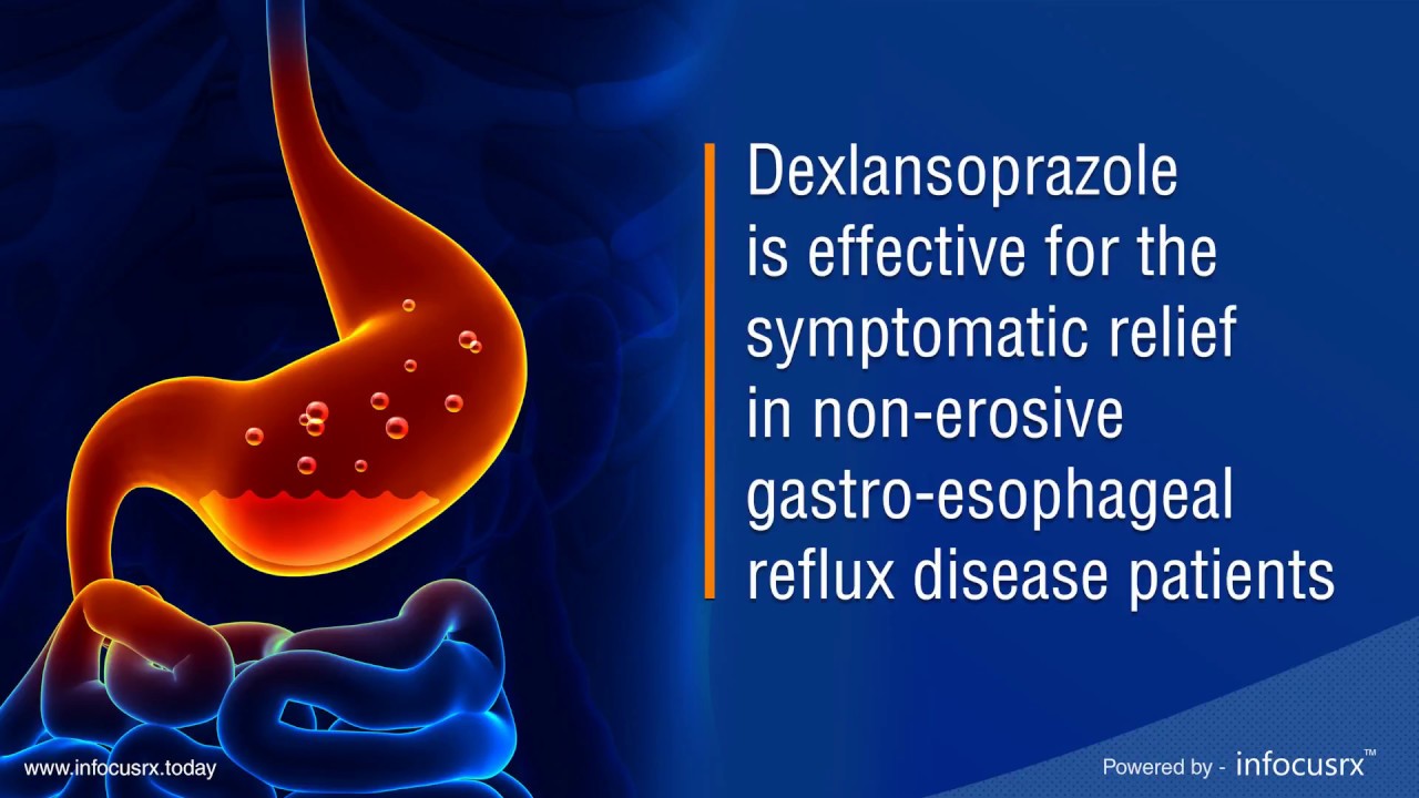 Dexlansoprazole is effective for symptomatic relief in non-erosive ...