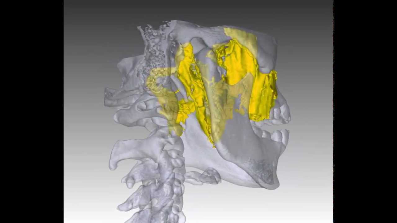 Bichat fat pad - YouTube