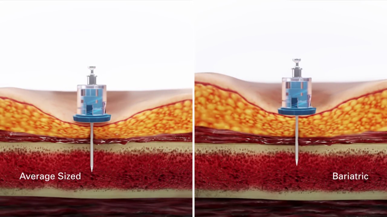 NIO™ Adult: Proximity to the Bone - YouTube