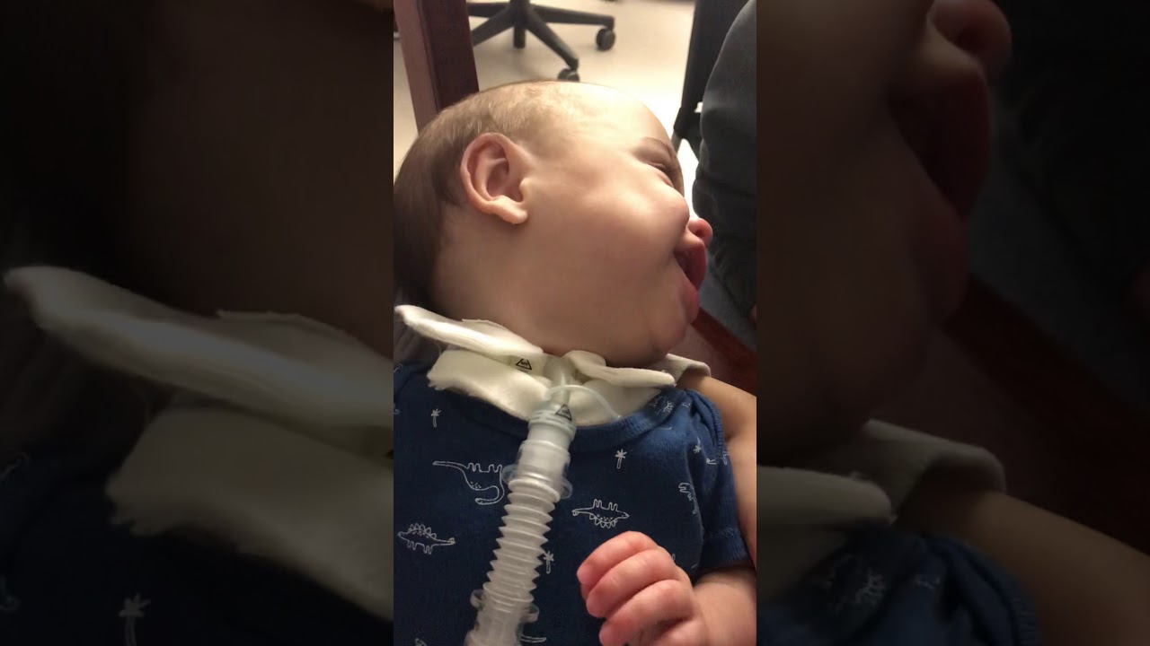 24 week micro preemie now 1 year old trach/vent baby - YouTube
