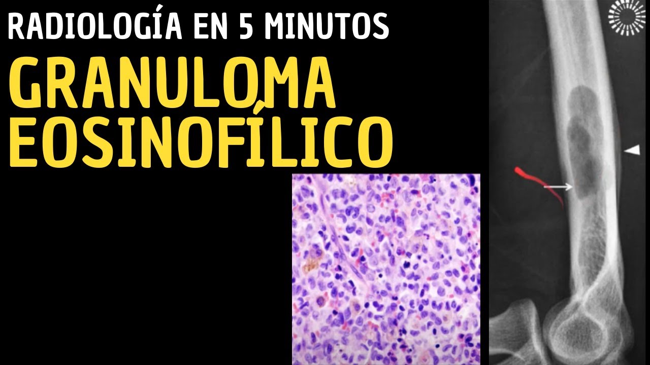 Radiología en 5 minutos: Granuloma eosinofílico. - YouTube