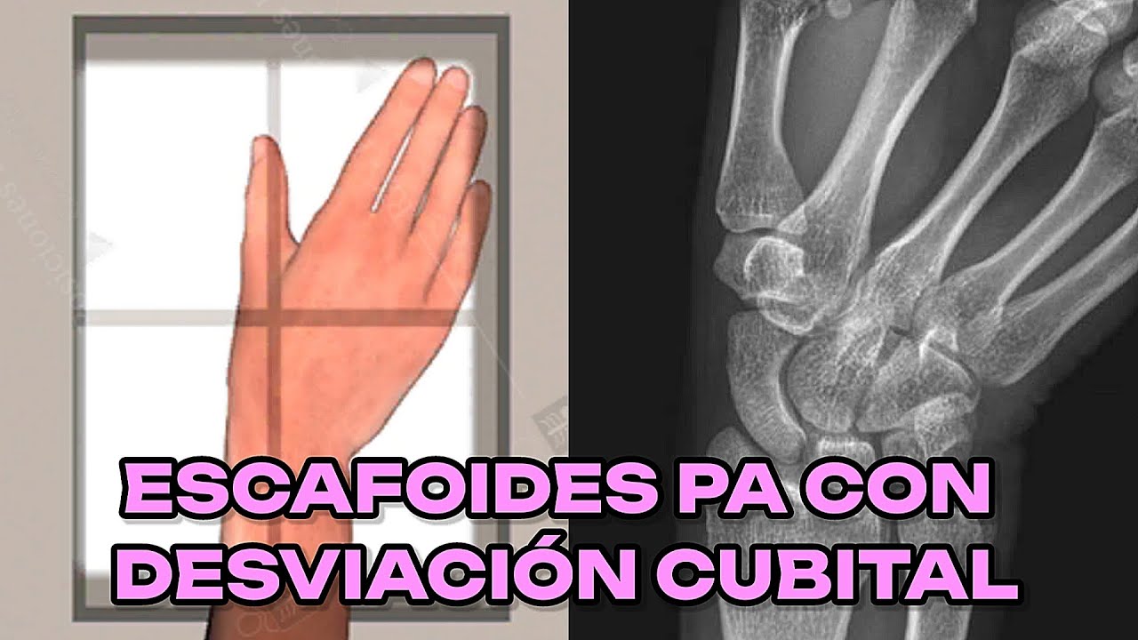 RADIOGRAFÍA DE ESCAFOIDES PA CON DESVIACIÓN CUBITAL (MANUAL DE BOLSILLO ...