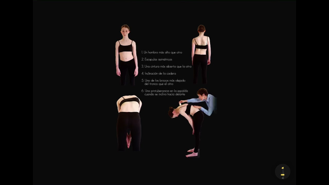 ESCOLIOSIS: TEST DE ADAMS. - YouTube