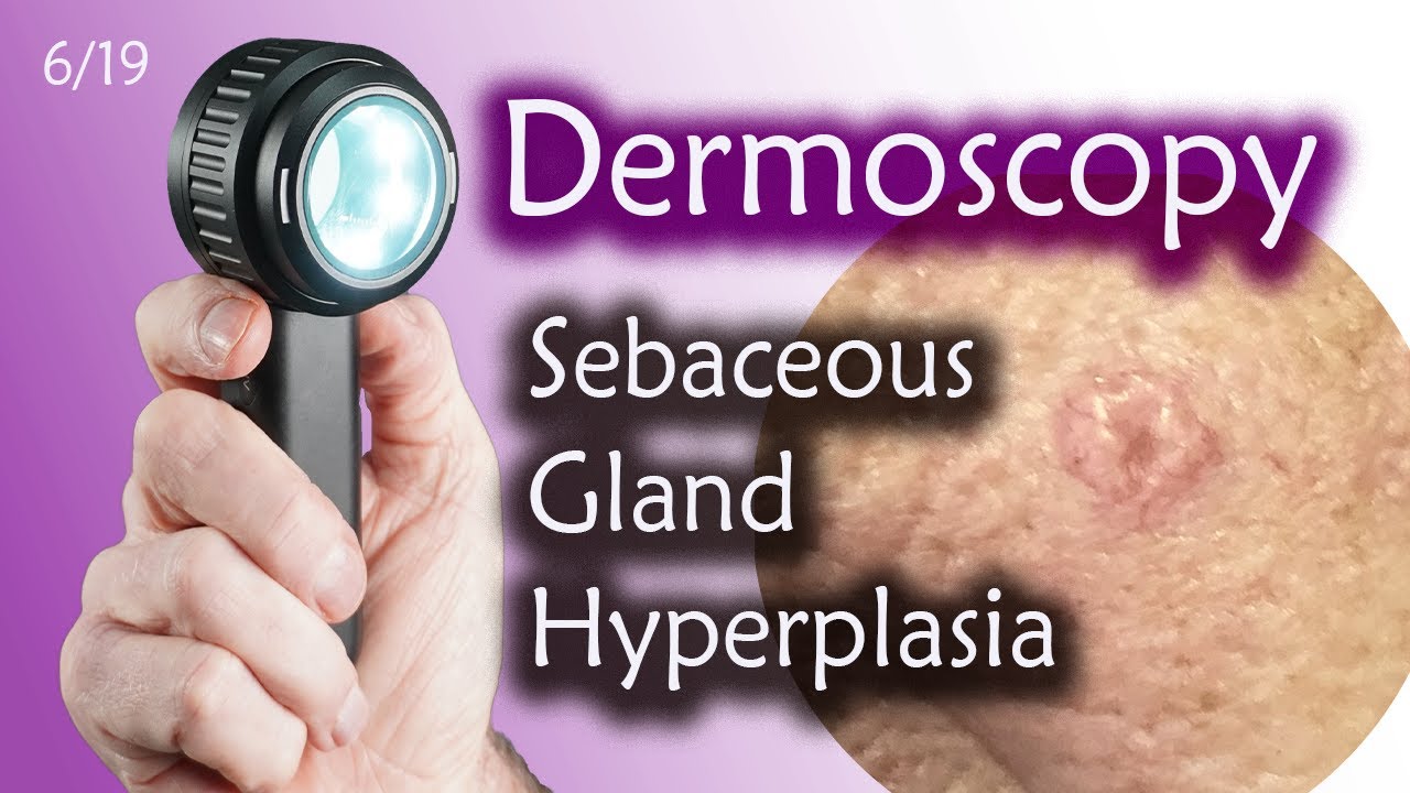 Sebaceous Gland Hyperplasia or BCC? - YouTube