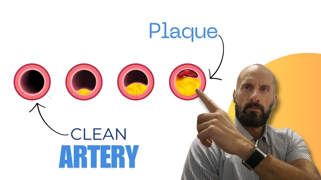 8 Powerful Ways to Reverse Arterial Damage - YouTube