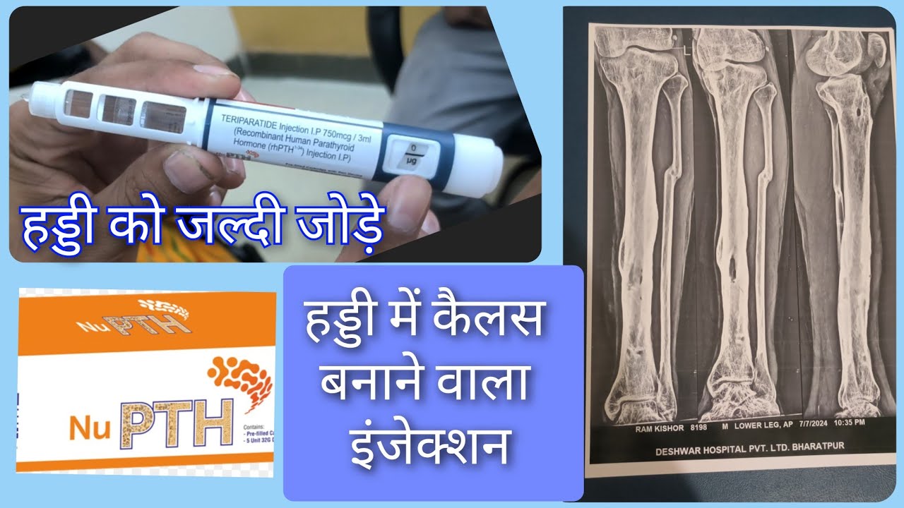 Delayed union/ haddi jaldi kaise jude/ fracture fast healing # ...