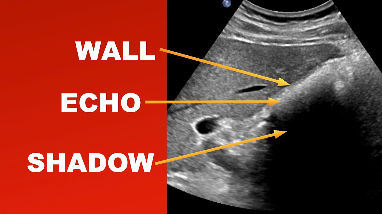 Wall echo shadow sign, WES sign of gall bladder - YouTube
