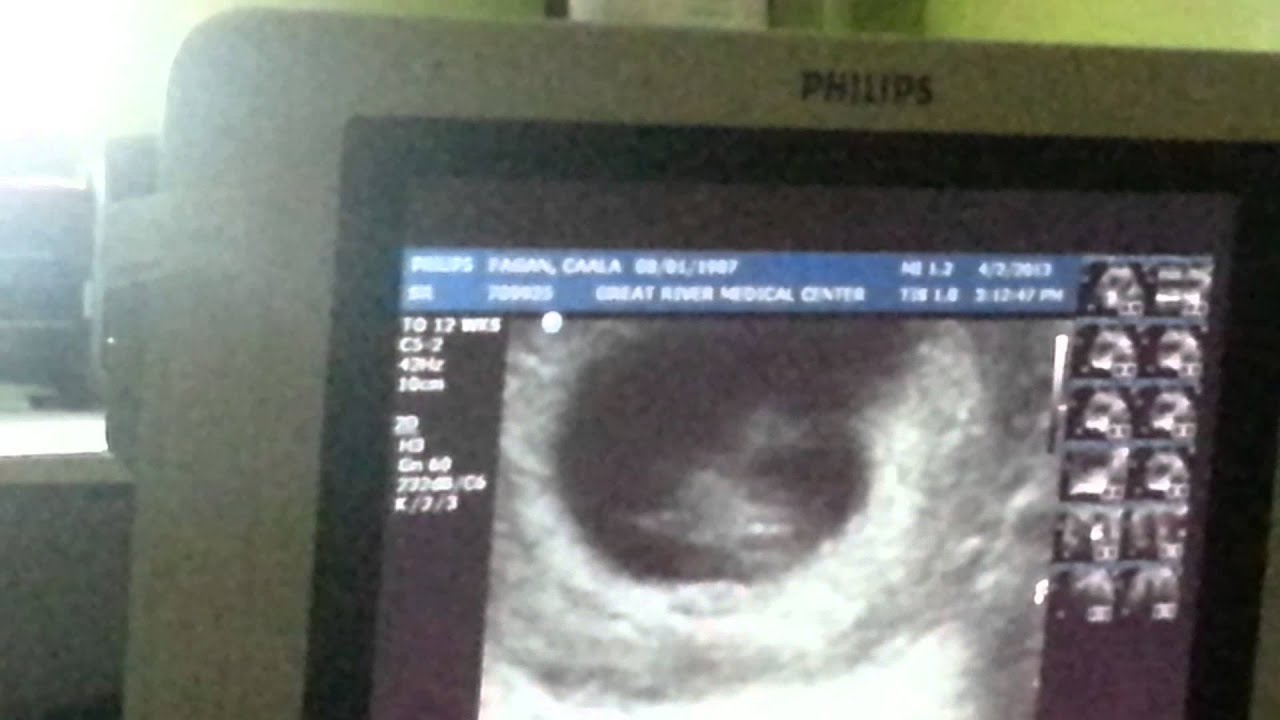 9 week, 2 day Ultrasound - YouTube