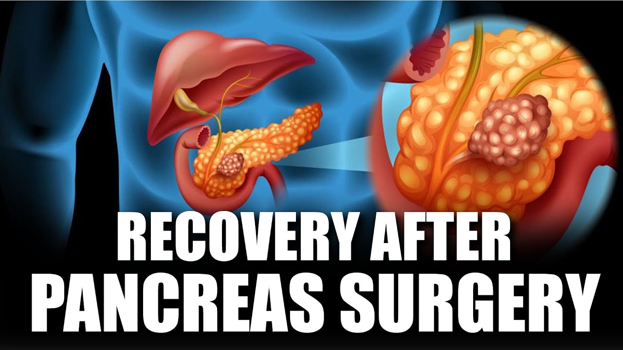 How Long is Recovery After Pancreas Surgery || Orange Health - YouTube