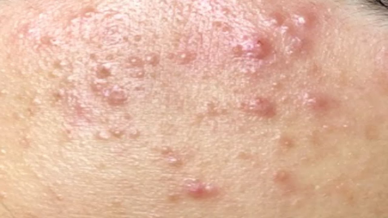 Satisfying Acne treatment (Hidden Acne extraction) - Enjoy every day ...