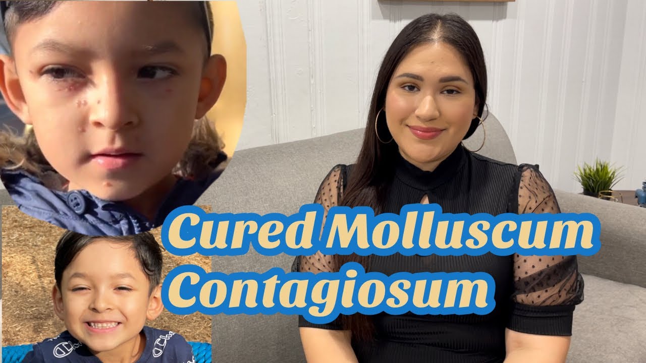 How we cured/treated molluscum contagiosum update 2021 ! How to get rid ...