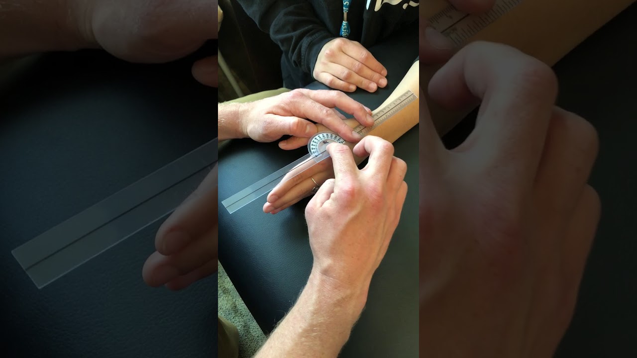 Goniometry Finger MCP Hyperextension - YouTube
