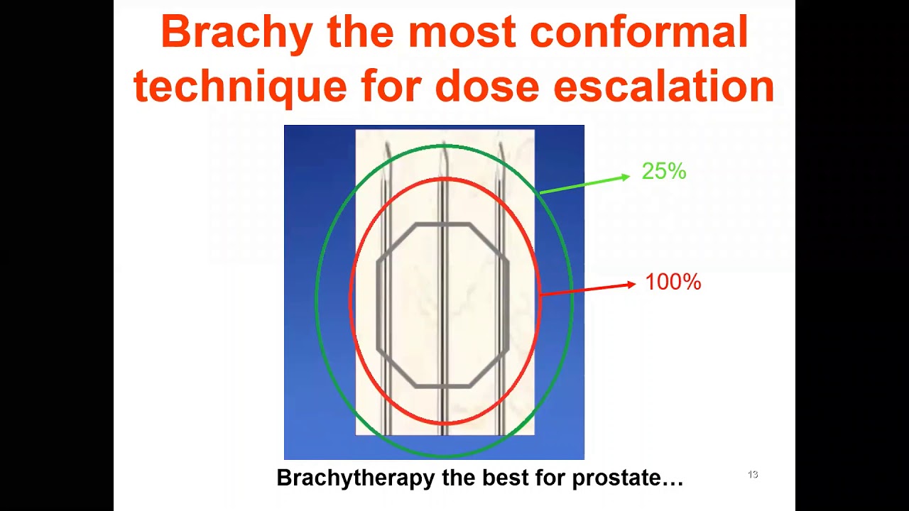 HDR Brachytherapy In Prostate Cancer Dr _Haresh K P - YouTube