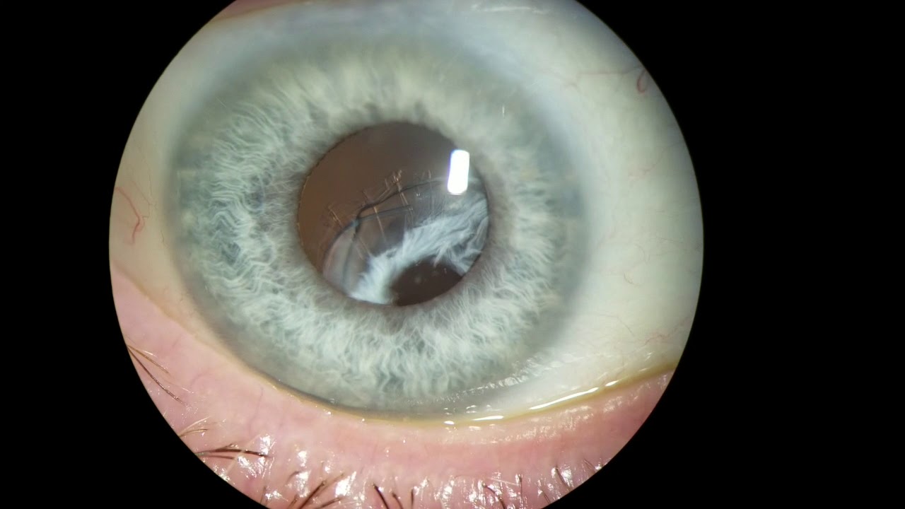 Usher syndrome with dislocated PCIOL - YouTube