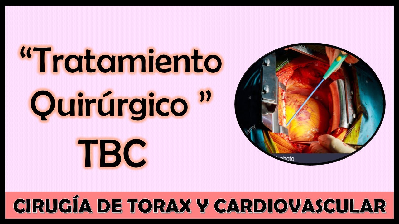 Tratamiento quirúrgico de la TBC - YouTube
