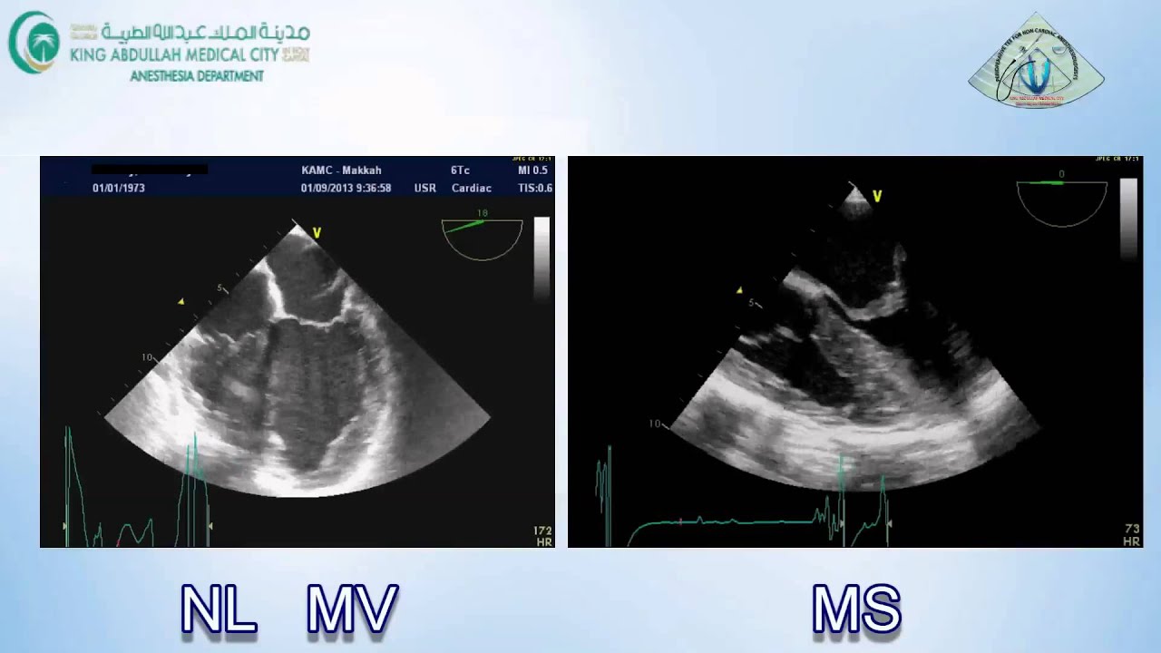 005 Mitral Stenosis TEE KAMC - YouTube