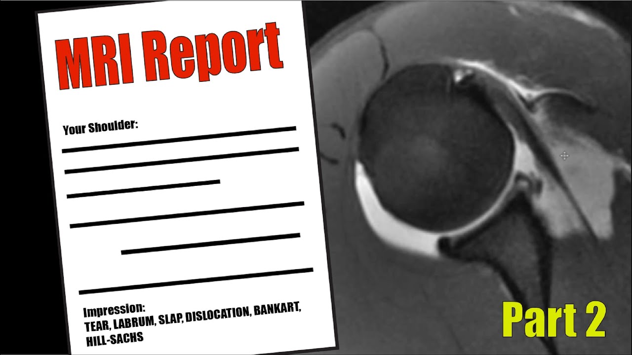 Shoulder DISLOCATION - Understand your MRI Report - YouTube