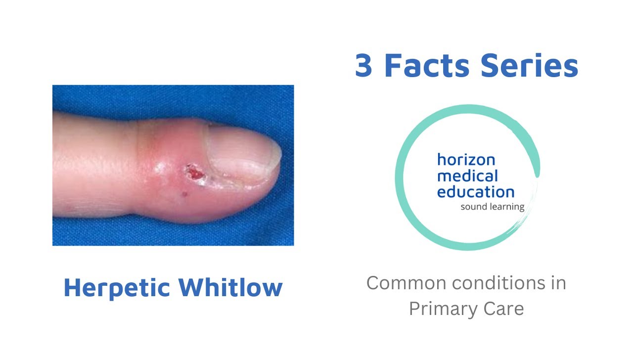 Herpetic Whitlow Finger Infections Painful Red Finger 3facts herpetic-whitlow-finger-infections-painful-red-finger-3facts