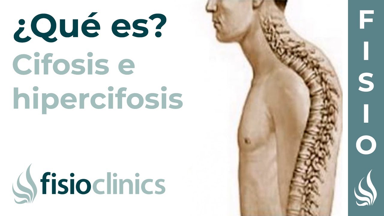 Cifosis e hipercifosis dorsal & Dorso plano. ¿Qué es? - FisioClinics ...