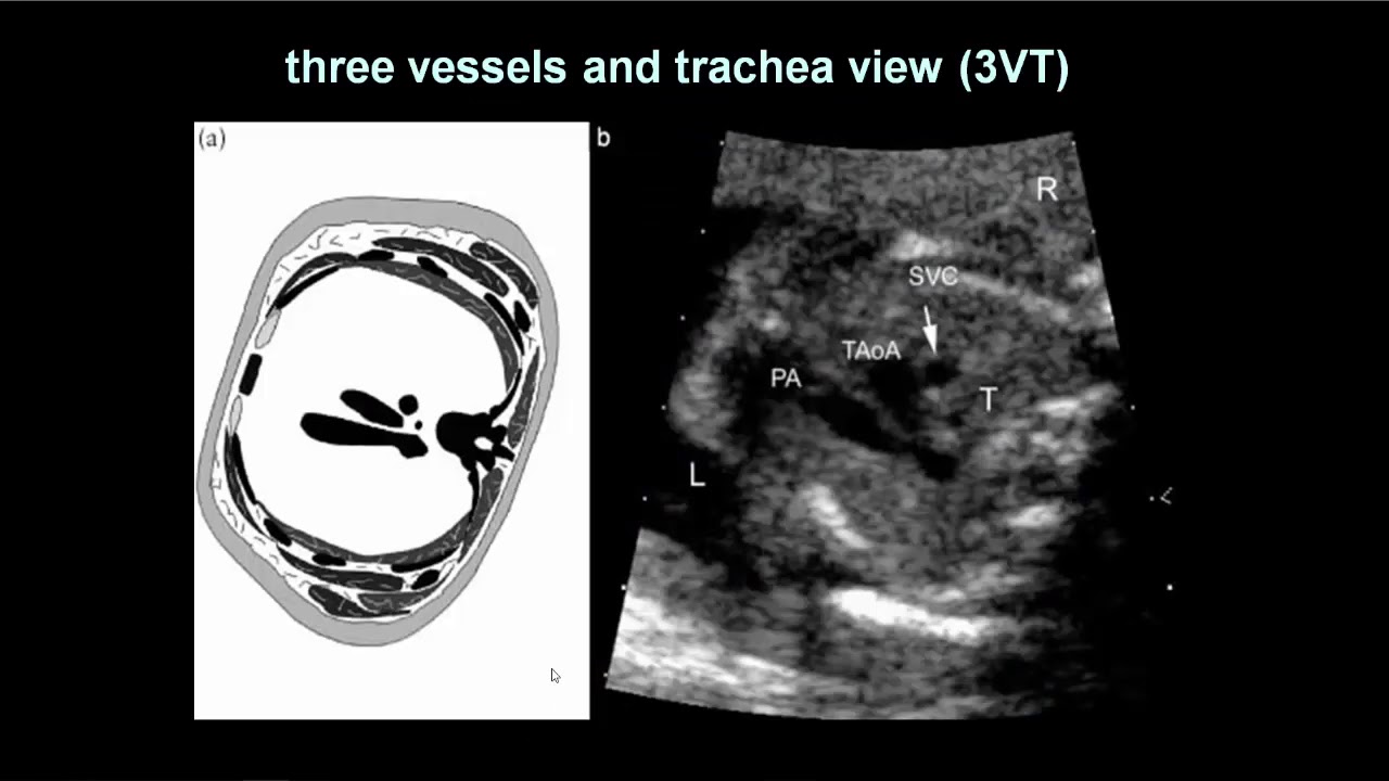 FETAL ECHO THREE VESSEL TRACHEA VIEW 3VT Dr Ahmed Esawy - YouTube