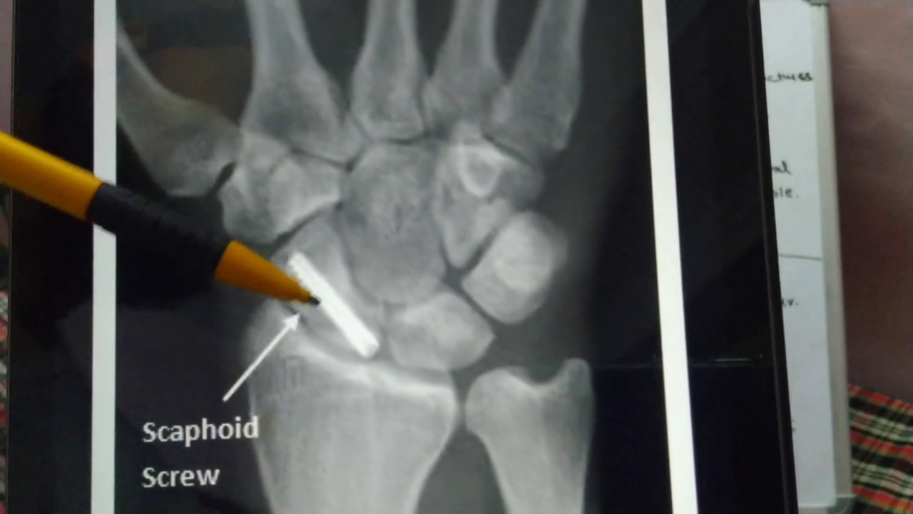 Scaphoid Fracture 2 Management Youtube