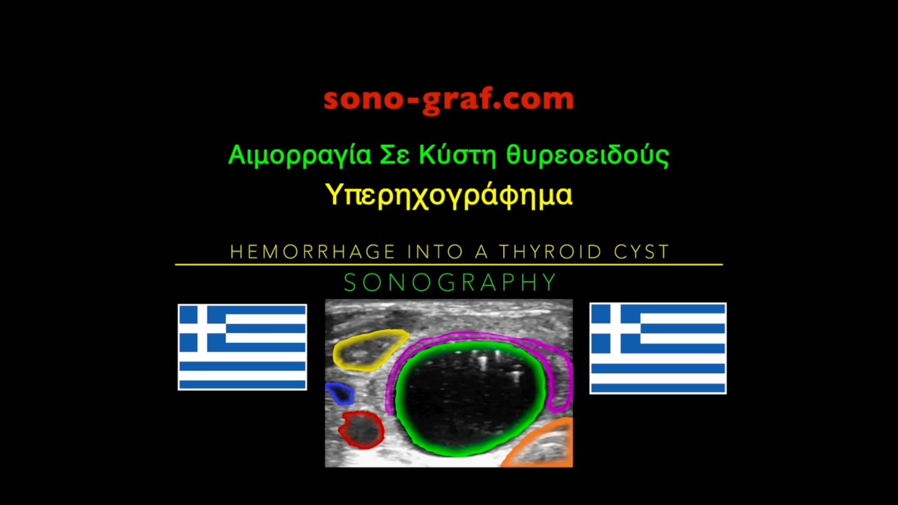 Υπερηχογράφημα - Αιμορραγία Σε Κύστη θυρεοειδούς - YouTube