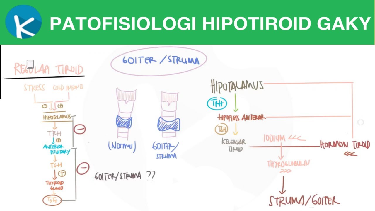 Patofisiologi Hipotiroid (Akibat Kekurangan Yodium) - YouTube