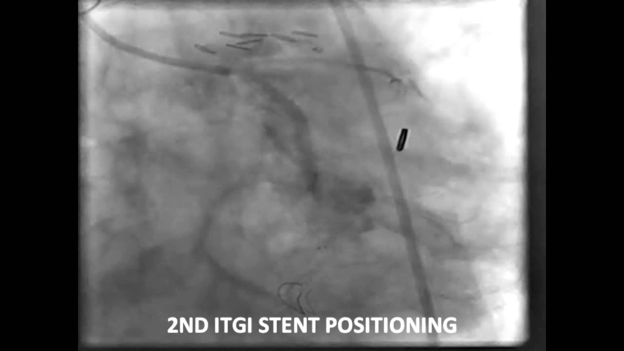 PERICARDIUM COVERED STENT FOR CORONARY PERFORATION - YouTube