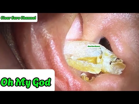 A tiny ear hides a massive earwax chunk | Ear Wax Removal Pro - YouTube