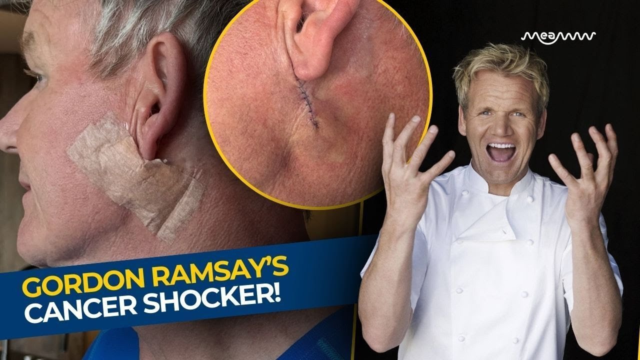 Gordon Ramsay Shares Skin Cancer Treatment! - YouTube