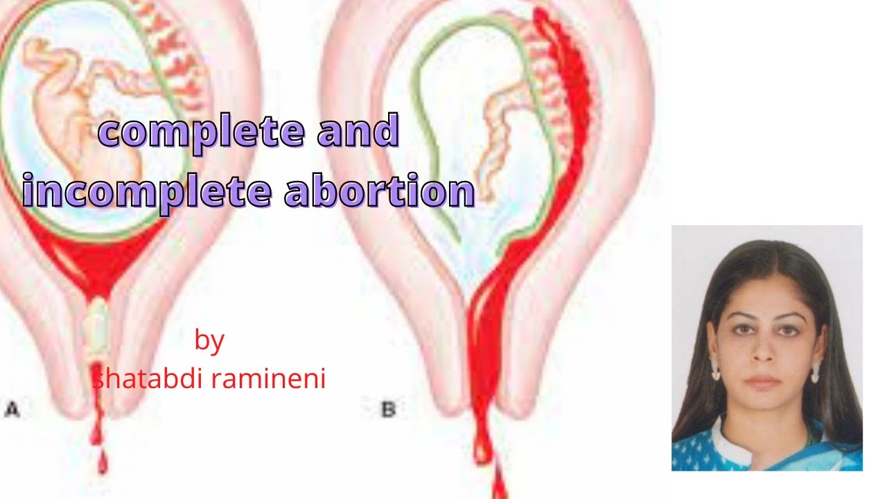 Complete and incomplete abortion - YouTube