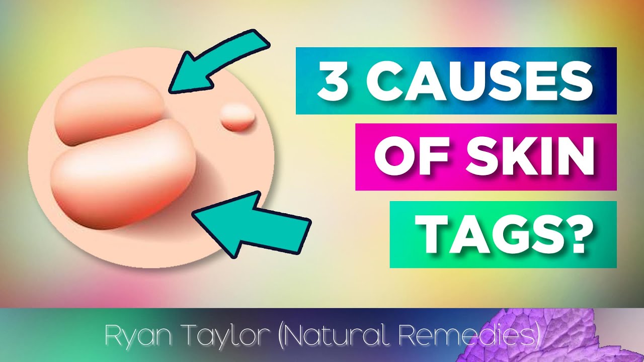 3 Causes Of Skin Tags - YouTube