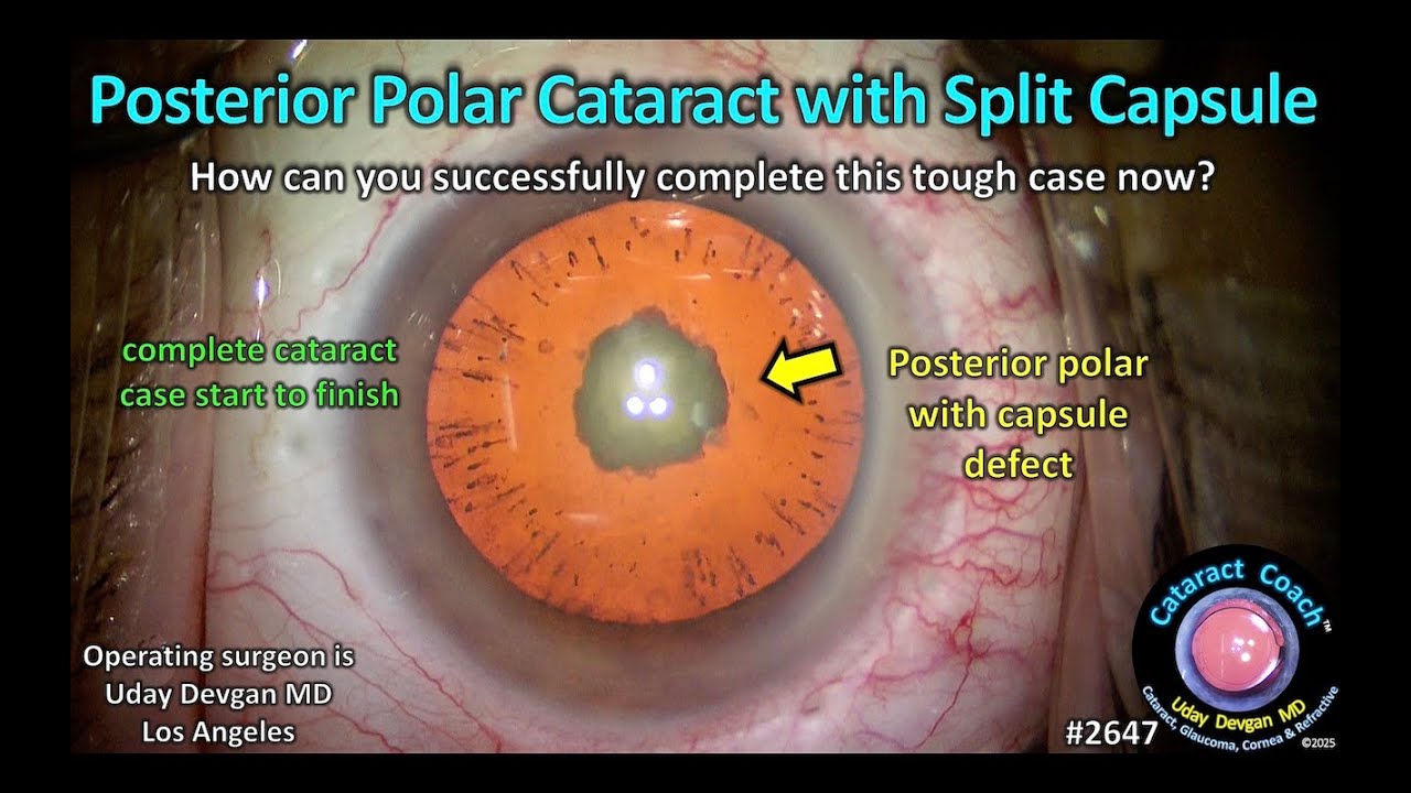 CataractCoach™ 2647: posterior polar cataract with split capsule - YouTube