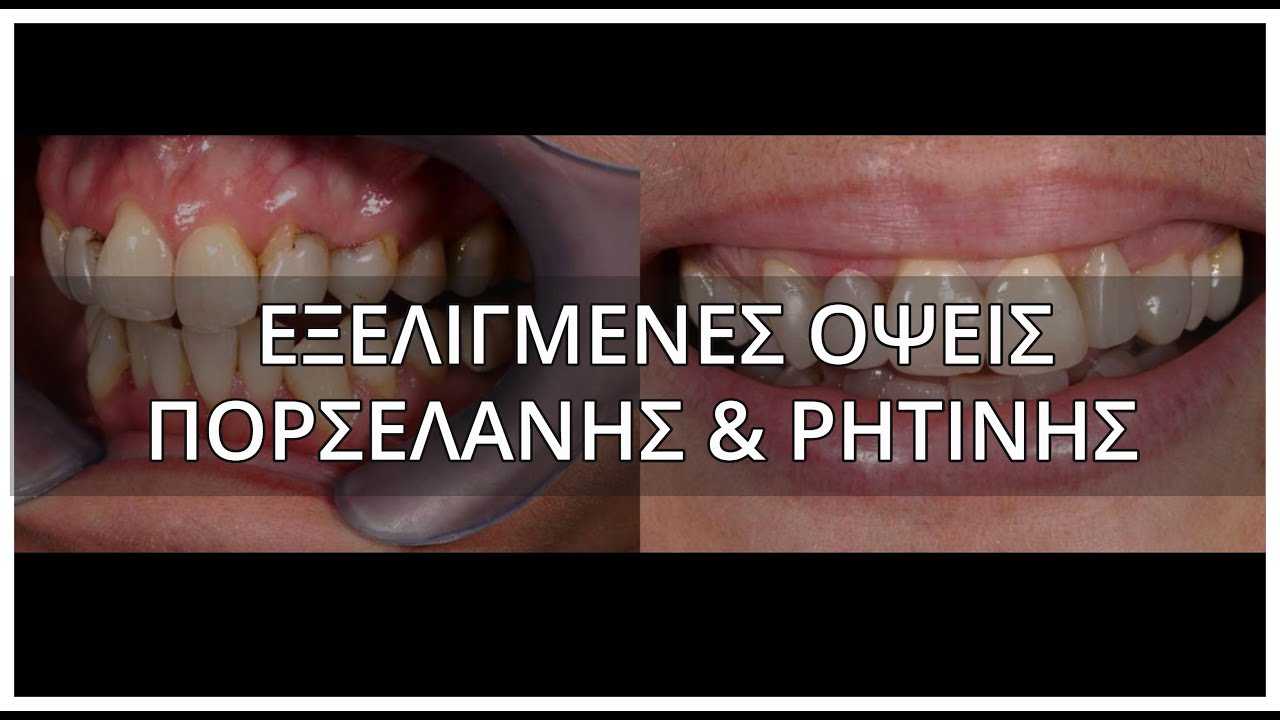 Στραβά δόντια με έλλειψη κυνόδοντα. 'Όψεις πορσελάνης | Dental ...