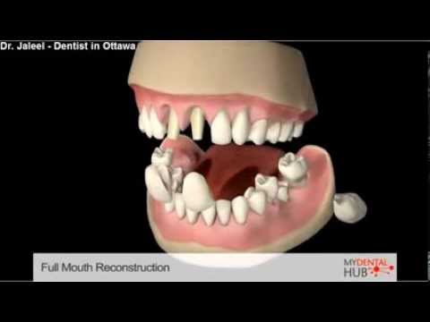 Implants - Full Mouth Reconstruction - Ottawa Dentists