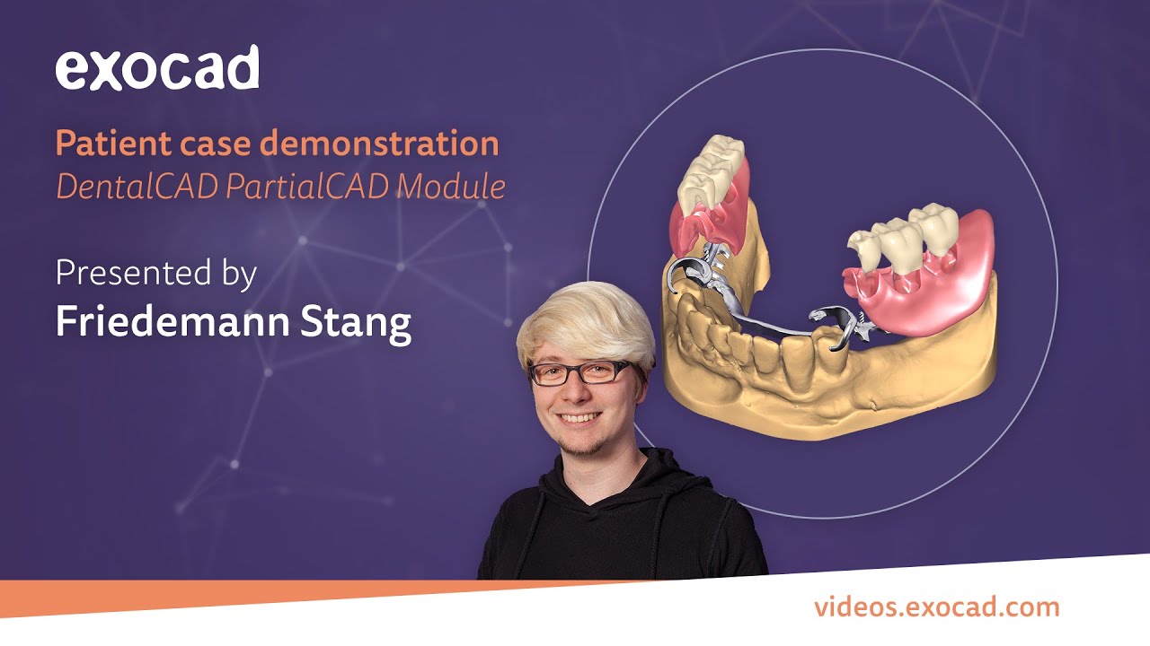 Patient Case Demonstration(3/6): DentalCAD PartialCAD Module - YouTube