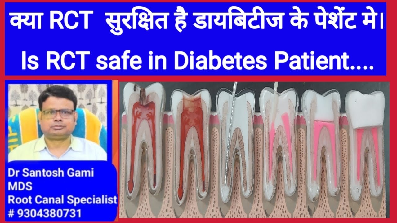 क्या RCT सुरक्षित है डायबिटीज के पेशेंट मे। Is RCT safe in Diabetes ...