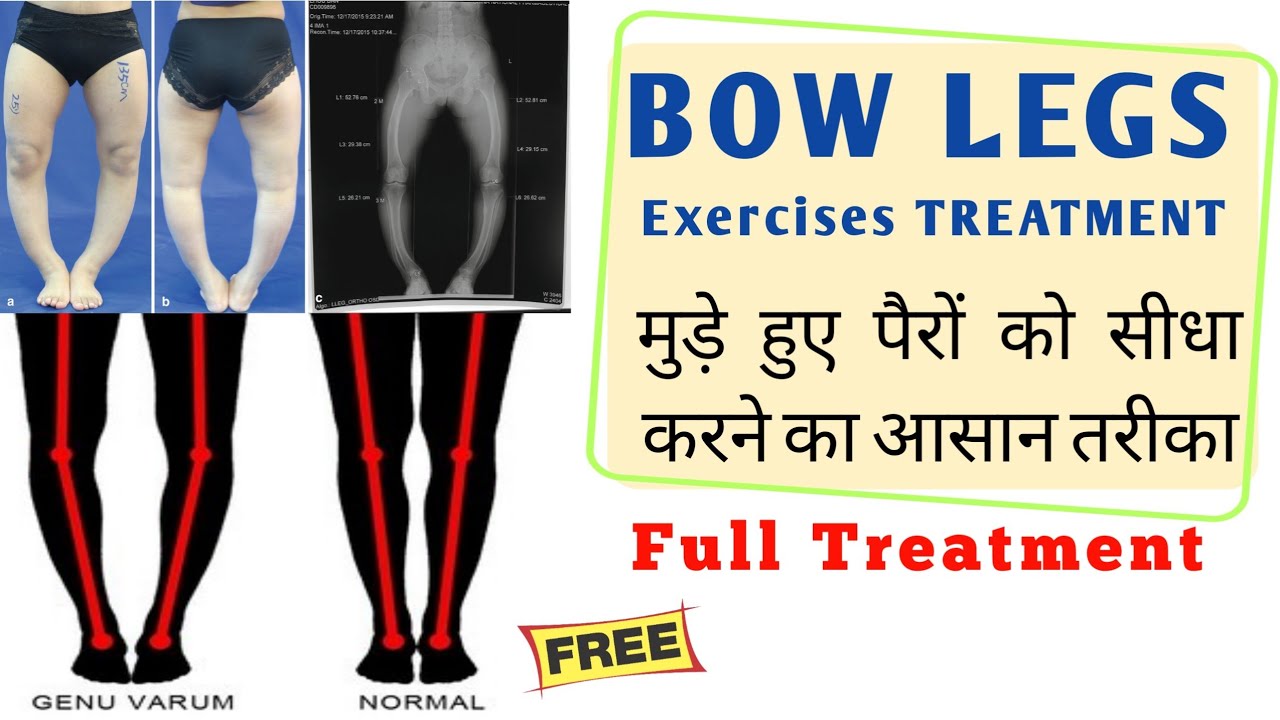 Bow legs correction exercises hindi, genu varum knee correction ...