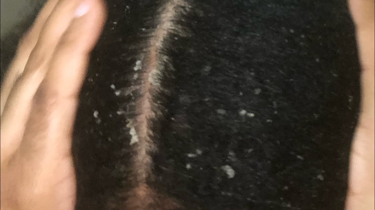 Dandruff Scratching Asmr No Talking Part 3 Youtube