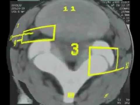 ANATOMIA BASICA EN EL TAC LUMBO / SACRO RADIOLOGIA - YouTube