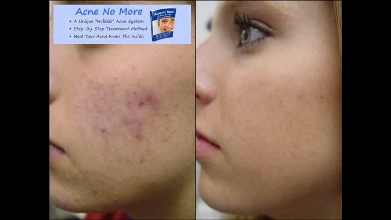 Fastest Way To Get Rid Of Red Acne Marks YouTube fastest-way-to-get-rid-of-red-acne-marks-youtube